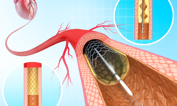 Peripheral Stents - Avante Medical