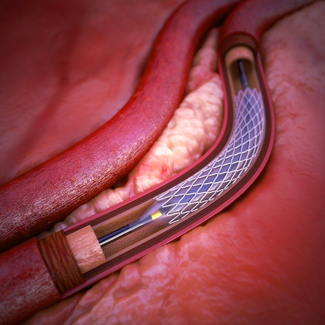 Stents - Avante Medical